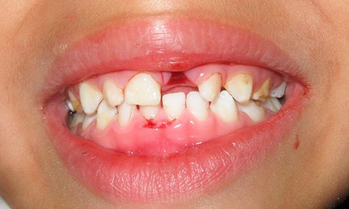 Avulsión dental: causas y tratamiento | Clínica dental Ferrus & Bratos