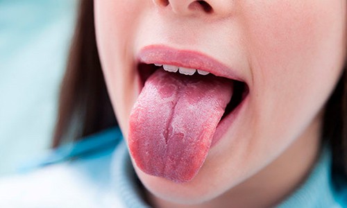 Glosodinia O Síndrome De La Boca Ardiente Clínica Dental Ferrus Bratos