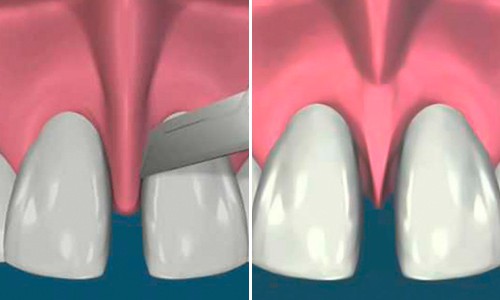 Frenillo labial: ¿cuándo hay que operarlo? | Clínica dental Ferrus & Bratos