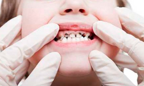 Caries rampante o de biberón: ¿por qué sale? |Clínica Ferrus & Bratos