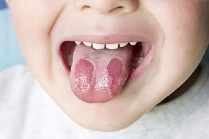 Macroglosia: ¿cuál es el tratamiento más indicado? | Ferrus & Bratos