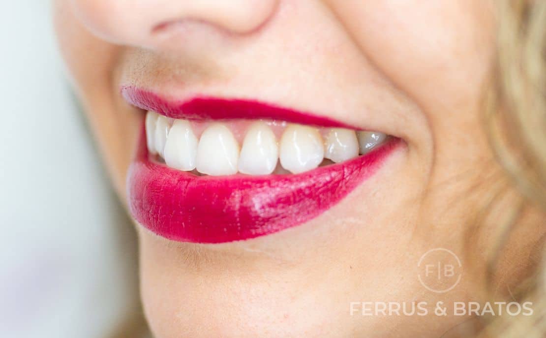 Técnica Pinhole: ¿en qué consiste y cuándo se emplea?