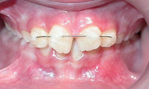 Avulsión dental: causas y tratamiento | Clínica dental Ferrus & Bratos