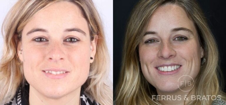 Solución a los colmillos montados: adultos y niños | Ferrus&Bratos