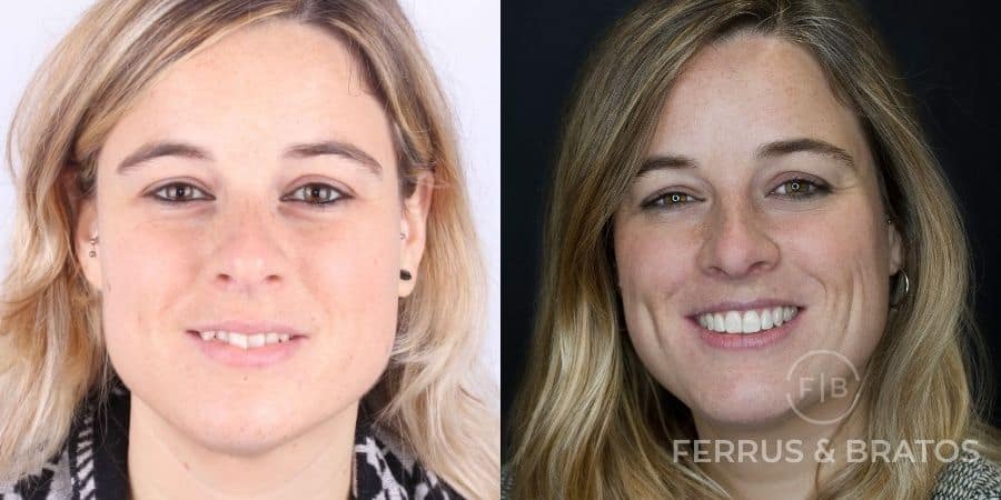 Solución a los colmillos montados: adultos y niños | Ferrus&Bratos