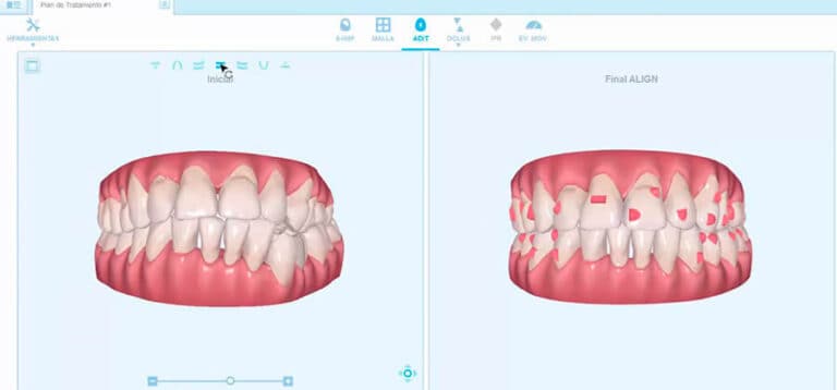 ¿Qué es el ClinCheck de Invisalign? | Ferrus&Bratos
