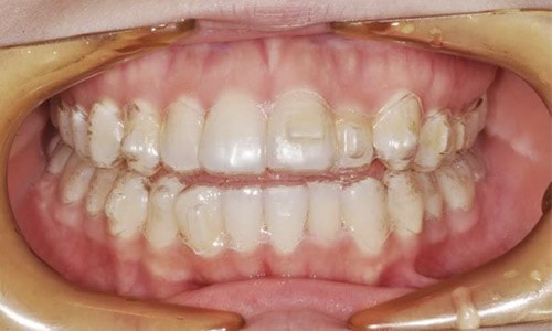 ¿Para qué sirven los ataches en Invisalign? - Ferrus & Bratos