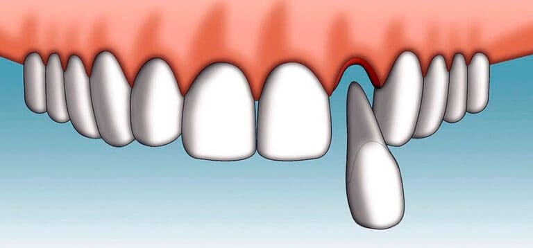 Avulsión dental: causas y tratamiento | Clínica dental Ferrus & Bratos