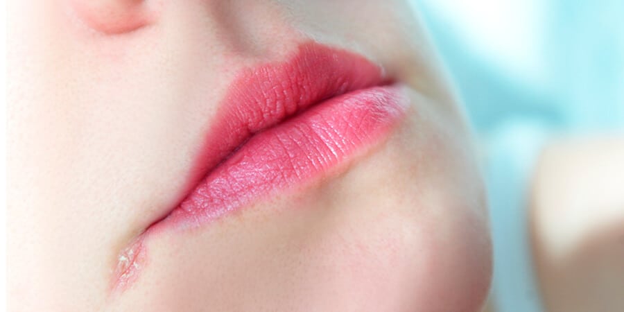 ¿Por qué salen las boqueras? Causas y tratamiento | Ferrus & Bratos