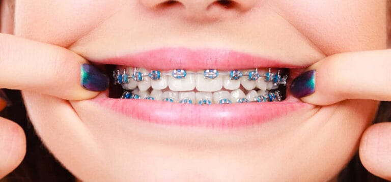 Brackets autoligables: ¿por qué elegirlos? | Ferrus&Bratos