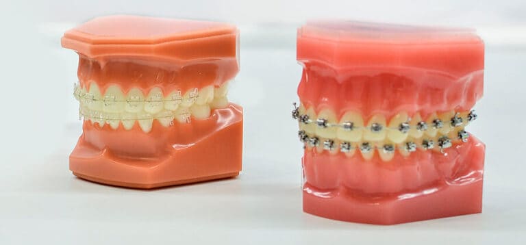 Brackets transparentes: precio y ventajas | Ferrus&Bratos