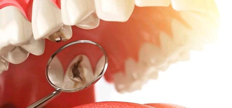 Absceso dental: causas, tratamiento y prevención | Ferrus&Bratos