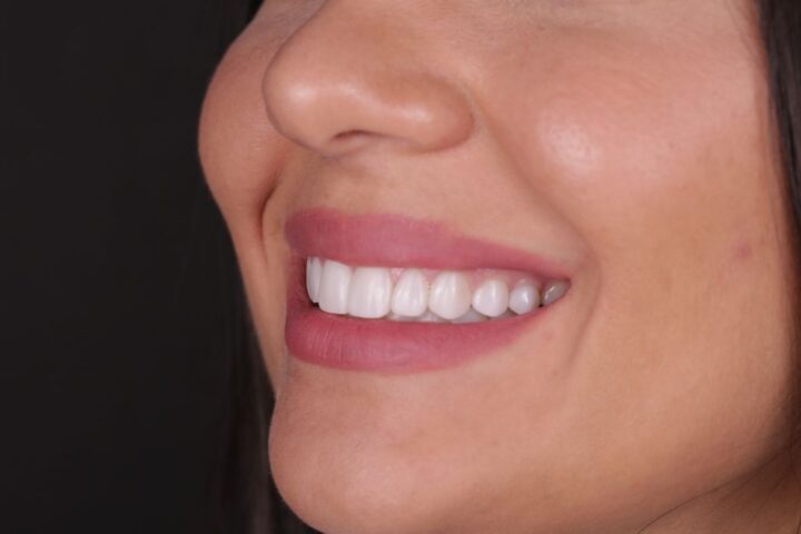 Solución a los colmillos montados: adultos y niños | Ferrus&Bratos