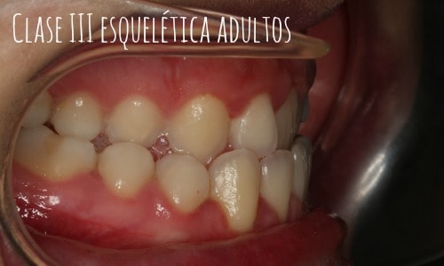 ¿Cómo corregir una maloclusión CLASE III con ortodoncia?
