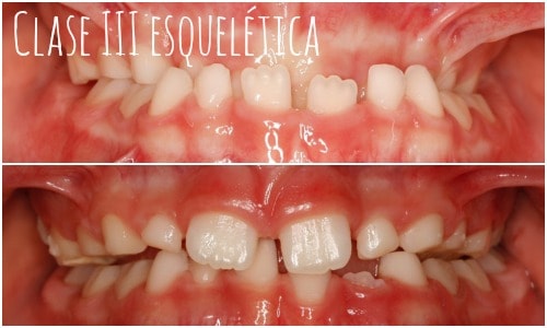 ¿Cómo corregir una maloclusión CLASE III con ortodoncia?