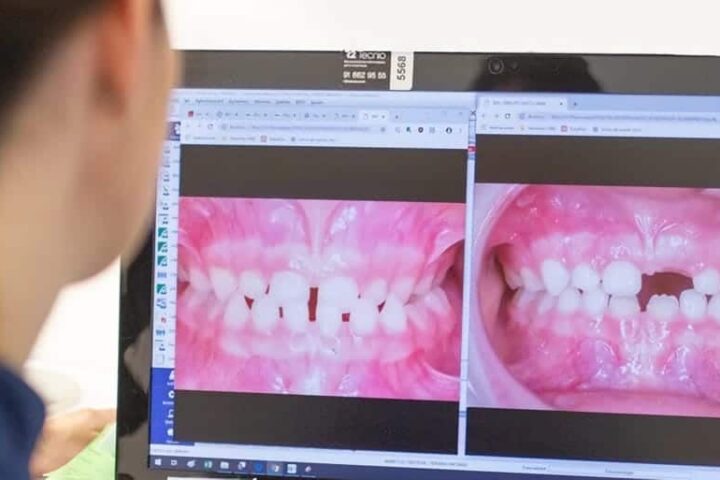 Protrusión dental: ¿cuál es su impacto y cómo se corrige?