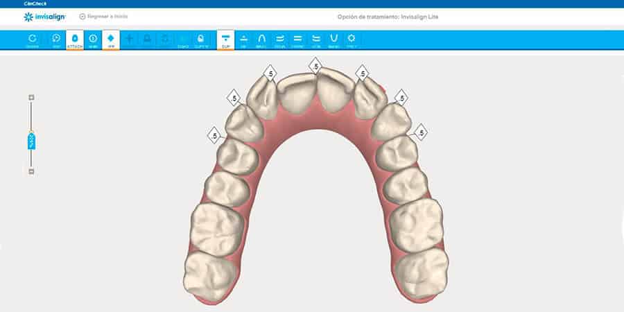 Invisalign Lite: precios y ventajas principales | 2023 | Ferrus&Bratos
