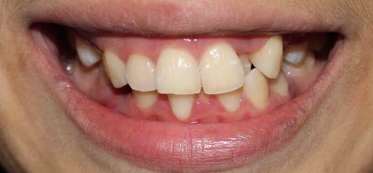 Tengo los colmillos montados: ¿cómo puedo corregirlos? | Ferrus&Bratos