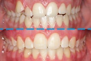 Tengo los colmillos altos: ¿qué puedo hacer para corregirlos?