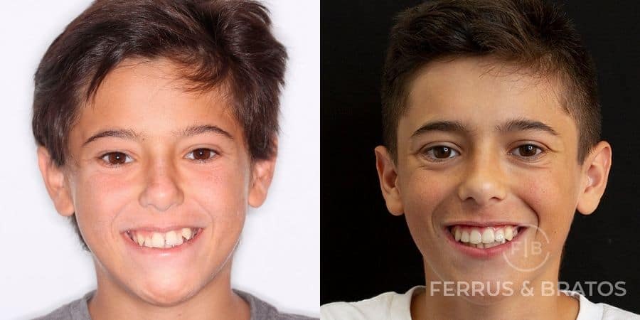 Solución a los colmillos montados: adultos y niños | Ferrus&Bratos