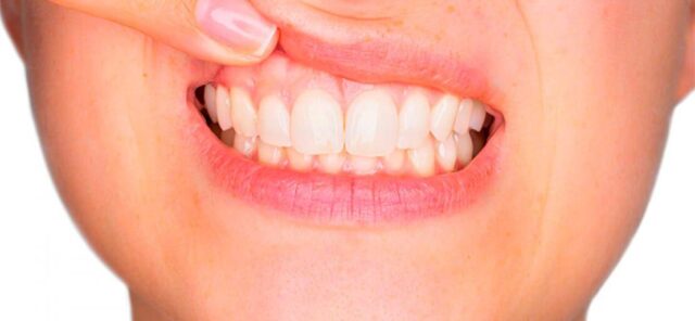 Encías: la importancia de mantenerlas sanas | Ferrus&Bratos