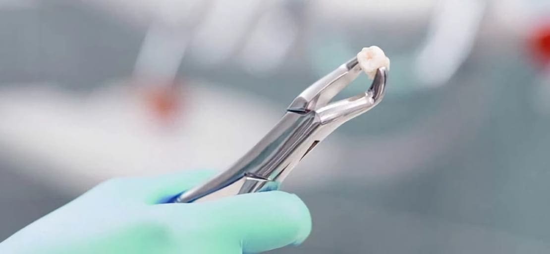 Infección de muela: ¿cómo se cura una muela infectada?