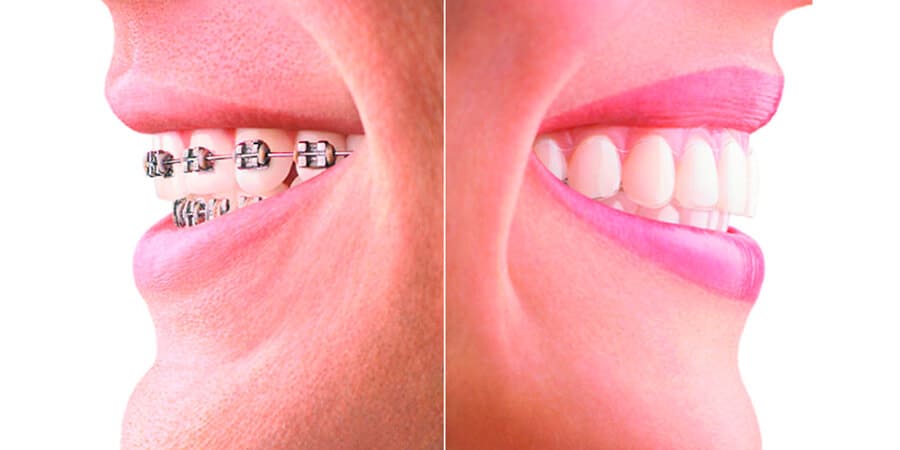 ¿Qué son los ataches en Invisalign y para qué sirven? | Ferrus&Bratos