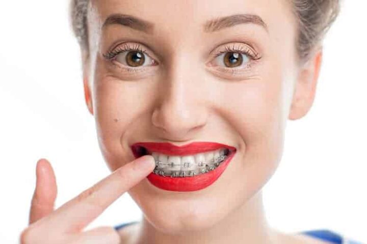 ¿Por qué me han puesto gomas en los brackets? | Ferrus&Bratos