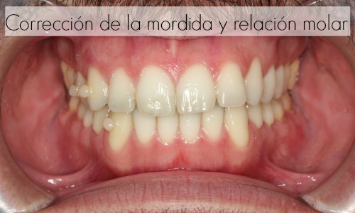 Las 7 FASES o etapas de un tratamiento de ortodoncia