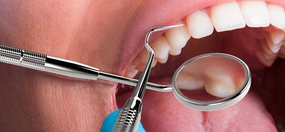 ¿Sabes qué es una cureta dental? | Ferrus&Bratos