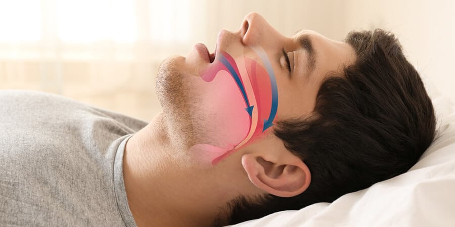 Aparato para no roncar: cómo elegir el mejor para mi | Ferrus&Bratos