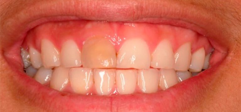 Diente calcificado: solución para dientes amarillos | Ferrus&Bratos