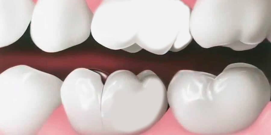 Dientes astillados: solución y causas | Ferrus&Bratos