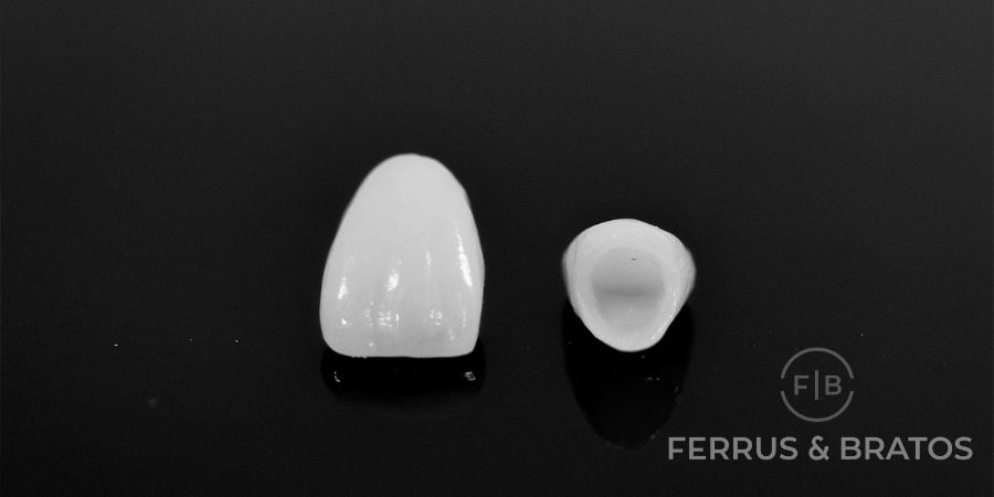 ¿Qué función tiene un diente provisional? | Ferrus&Bratos
