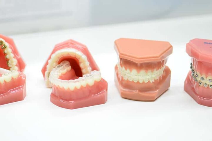 ¿Qué alimentos comer y NO comer con brackets? | Ferrus&Bratos