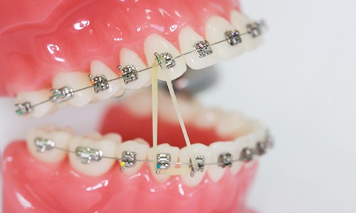 8 consejos que debes seguir cuando llevas ortodoncia