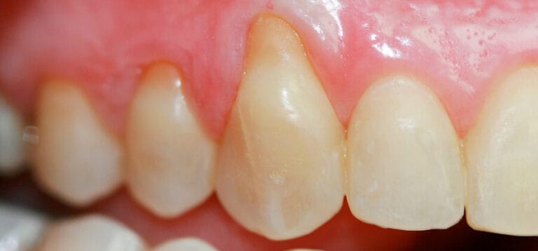 ¿Cómo se hace un injerto de encía? | Ferrus&Bratos