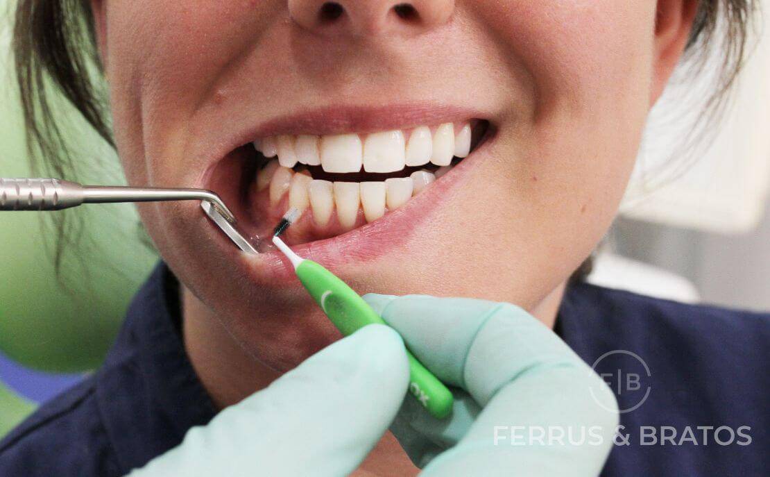 Raspado de encías: en qué consiste y por qué se hace | Ferrus&Bratos