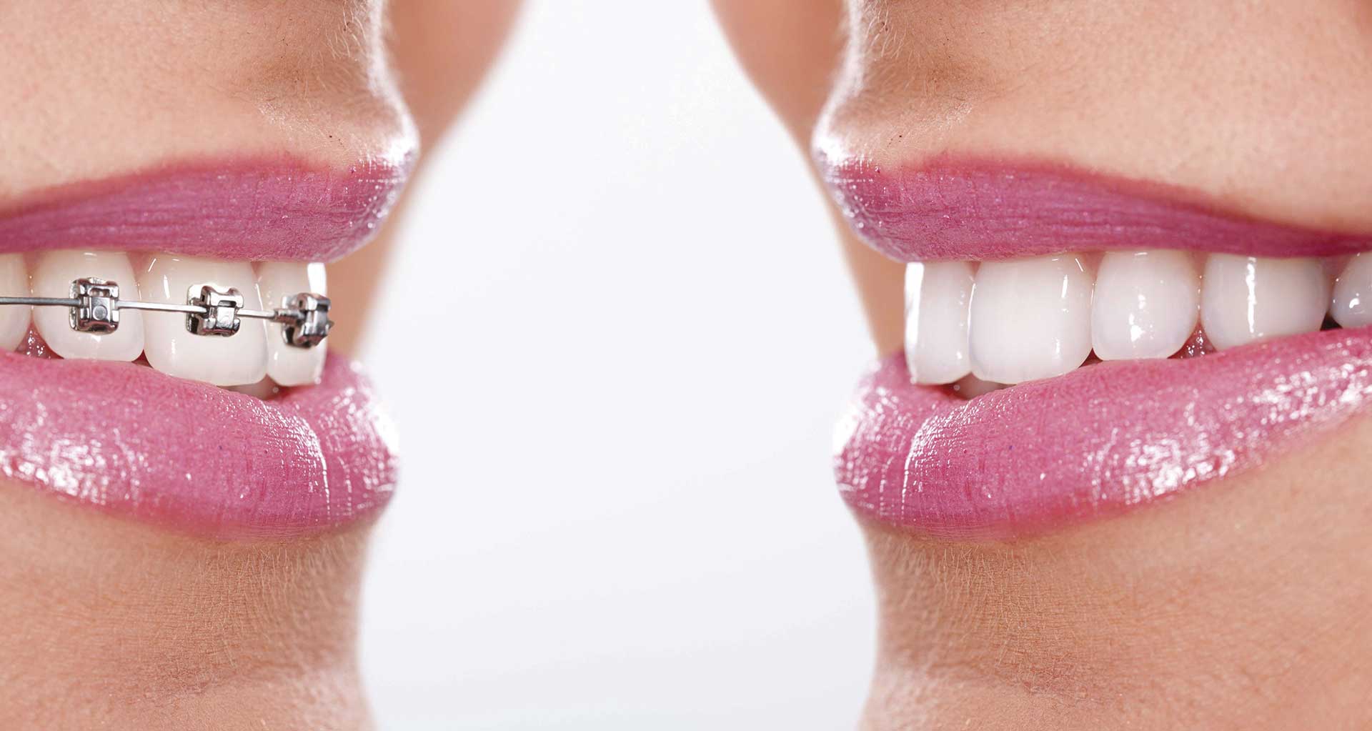 Las 7 FASES o etapas de un tratamiento de ortodoncia