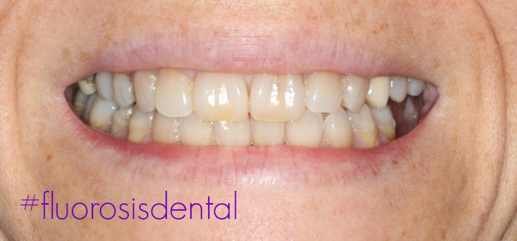 ¿Qué es la fluorosis dental? | Ferrus&Bratos