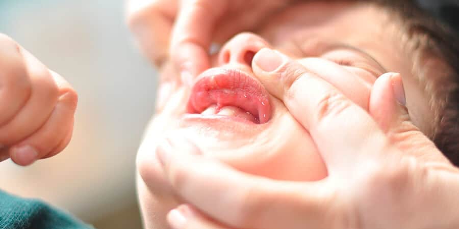 Frenillo de la boca: ¿cuándo hay que operarlo? | Ferrus&Bratos