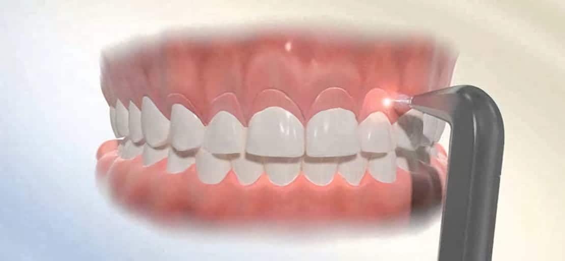 Gingivectomía: qué es, en qué consiste, beneficios y tratamiento