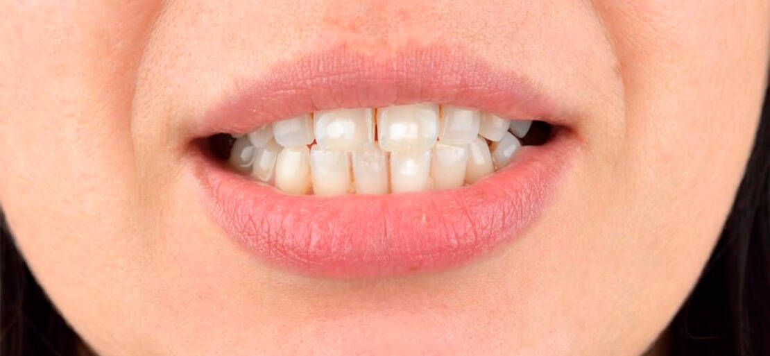 Hipocalcificación dental, ¿qué es y cómo afecta a tus dientes?
