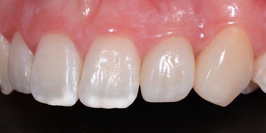 Hipocalcificación dental, ¿qué es y cómo afecta a tus dientes?