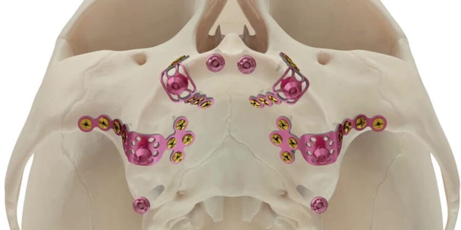 Implantes corticales, ¿buena opción si no tengo hueso dental?