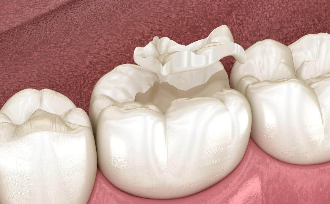 ¿Qué es una incrustación dental y cuándo se realiza? | Ferrus&Bratos