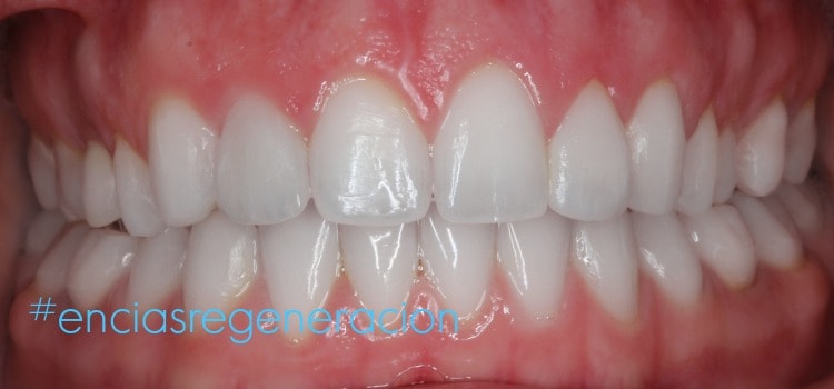Las encías se regeneran con el tratamiento adecuado
