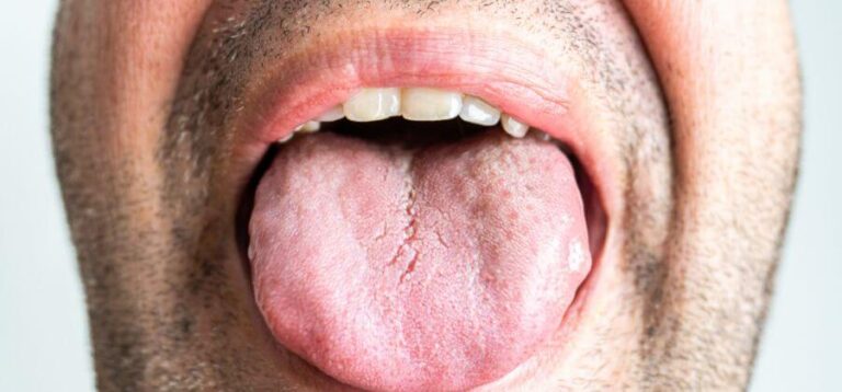 ¿Qué hago si tengo lengua agrietada? | Ferrus&Bratos