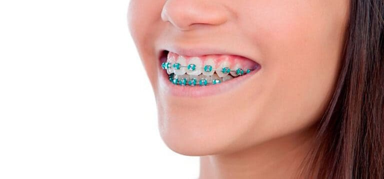 Brackets metálicos: ventajas y su precio | 2025 | Ferrus&Bratos