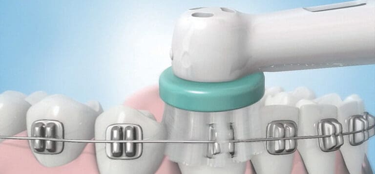 Brackets autoligables: ¿por qué elegirlos? | Ferrus&Bratos